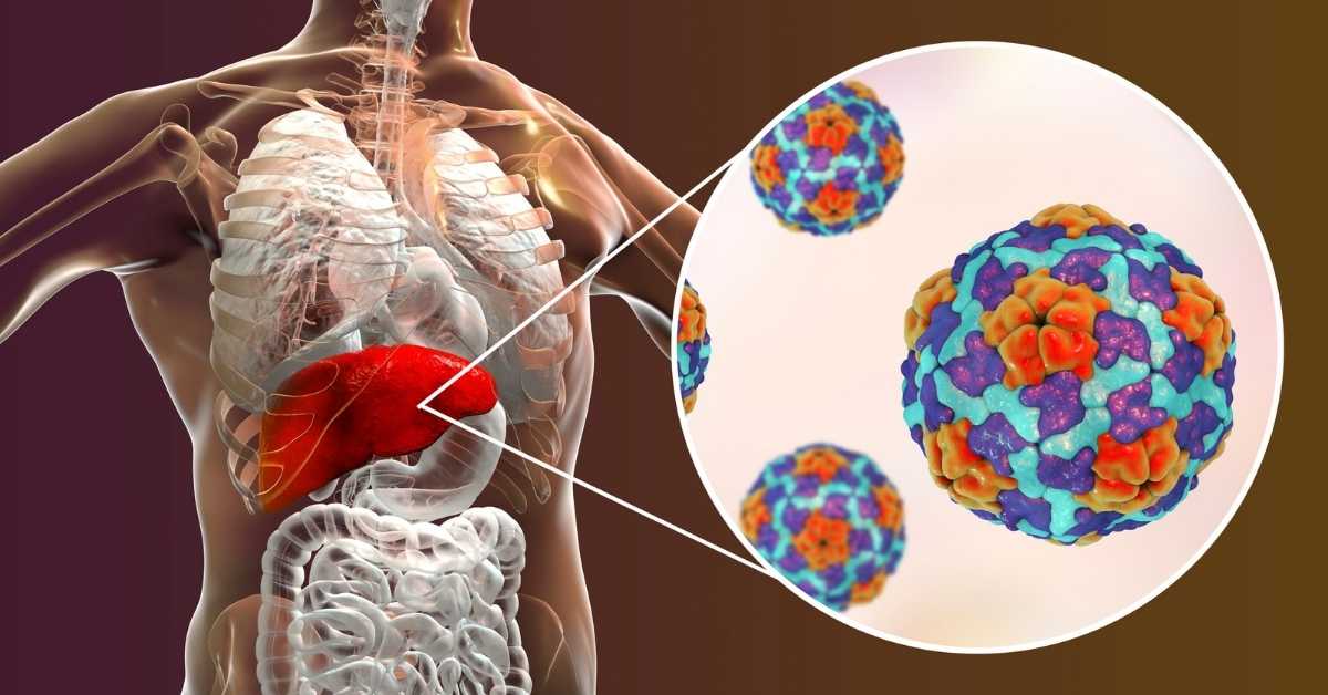 Bagaimana Pencegahan Hepatitis? Ini Jenis dan Pengobatannya