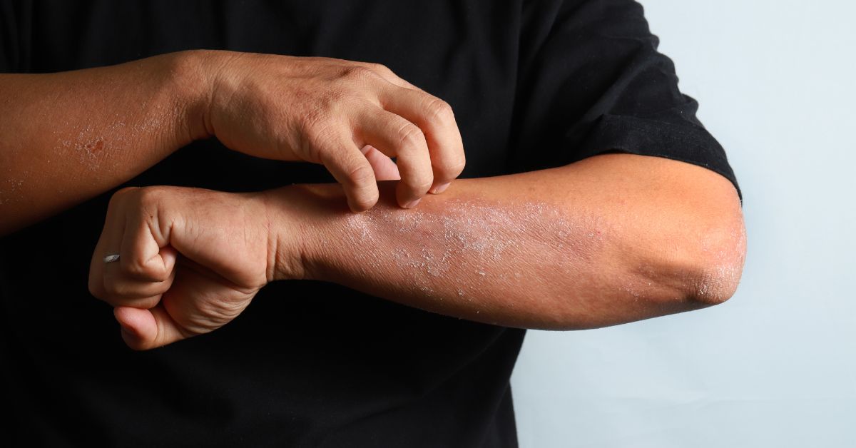 Penyakit Peradangan Kulit | Mandira Distra Abadi