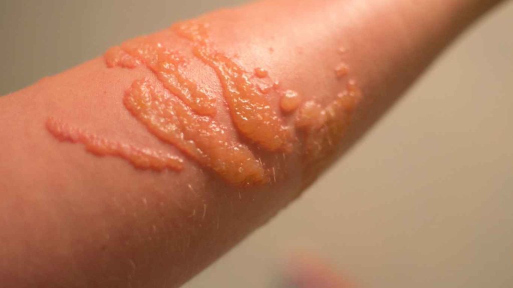 Waspada! Inilah 10 Ciri-ciri HIV Pada Kulit yang Dapat Anda Kenali ...