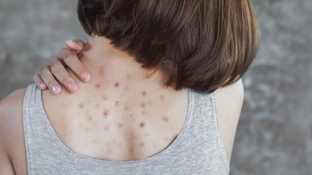 Waspada! Inilah 10 Ciri-ciri HIV Pada Kulit yang Dapat Anda Kenali ...