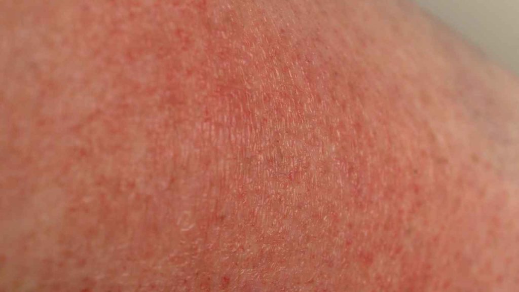 Waspada! Inilah 10 Ciri-ciri HIV Pada Kulit yang Dapat Anda Kenali ...