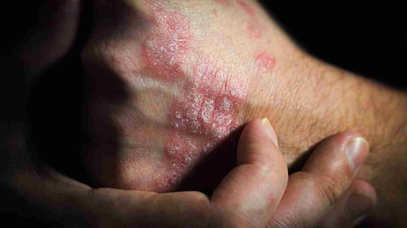 Apa itu Penyakit Kusta? Kenali Penyebabnya! | Mandira Distra Abadi