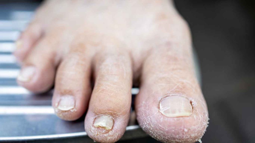 Waspada! Inilah 10 Ciri-ciri HIV Pada Kulit yang Dapat Anda Kenali ...