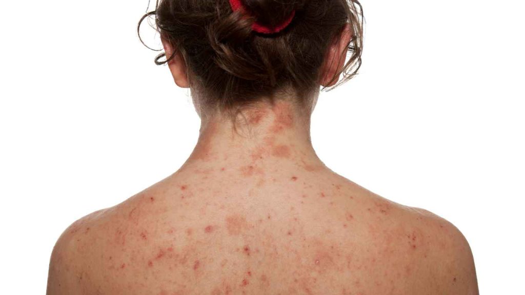 Waspada! Inilah 10 Ciri-ciri HIV Pada Kulit yang Dapat Anda Kenali ...