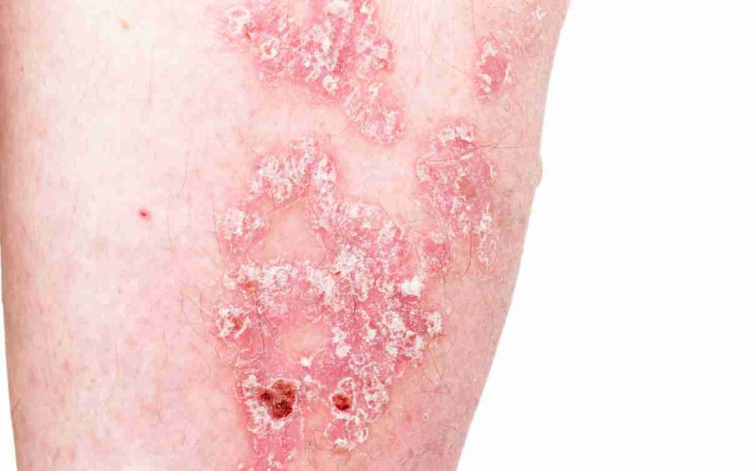 Jenis-jenis Penyakit Kulit Menular dan Cara Pengobatannya | Mandira Distra Abadi